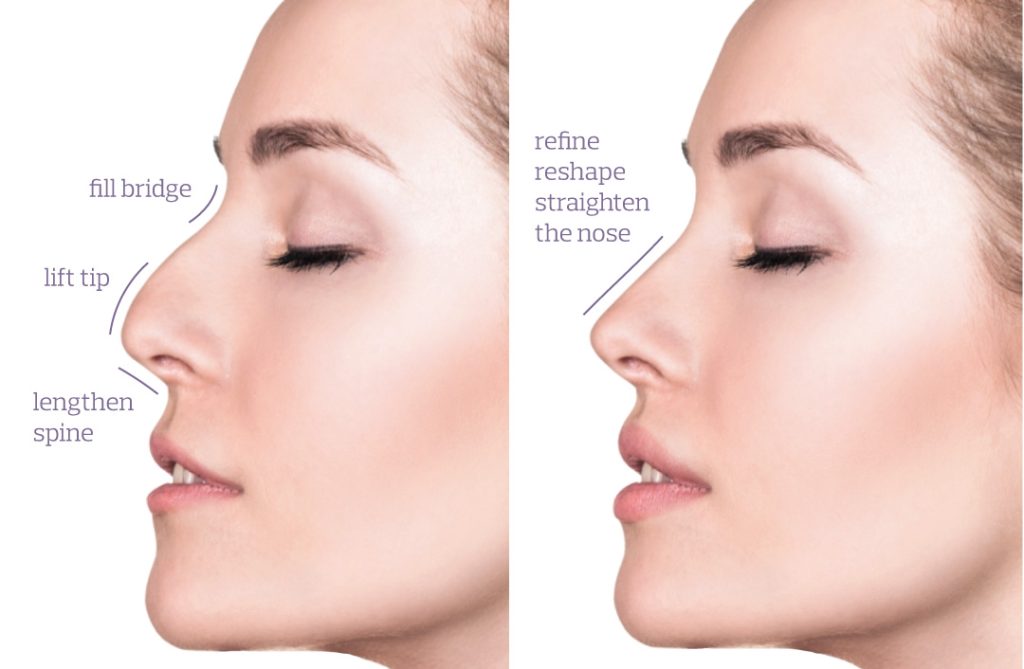 Nose Thread Lift - Non-Surgical Rhinoplasty Solution