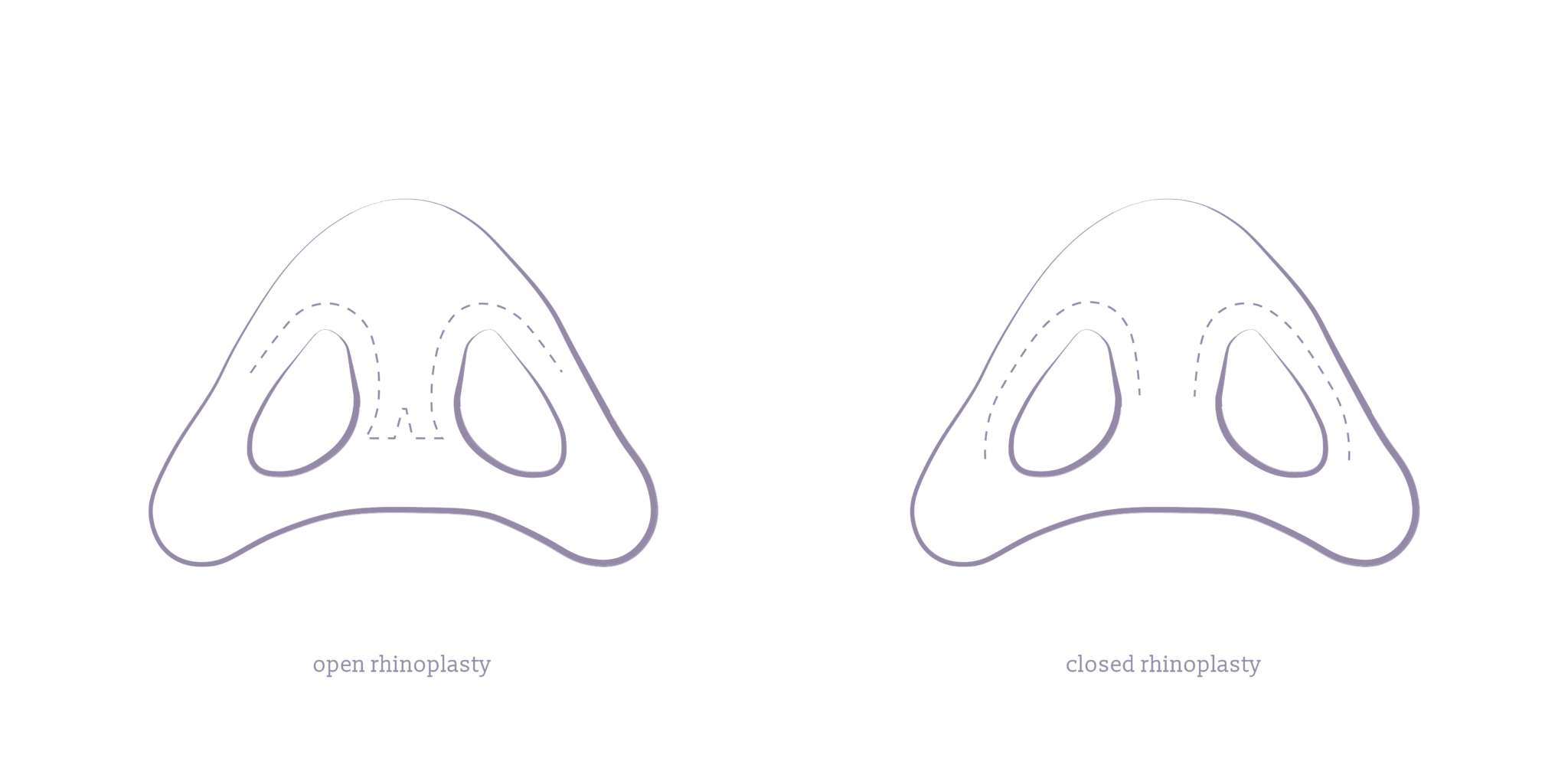 Septoplasty in Melbourne | Deviated Septum Surgery at Me Clinic
