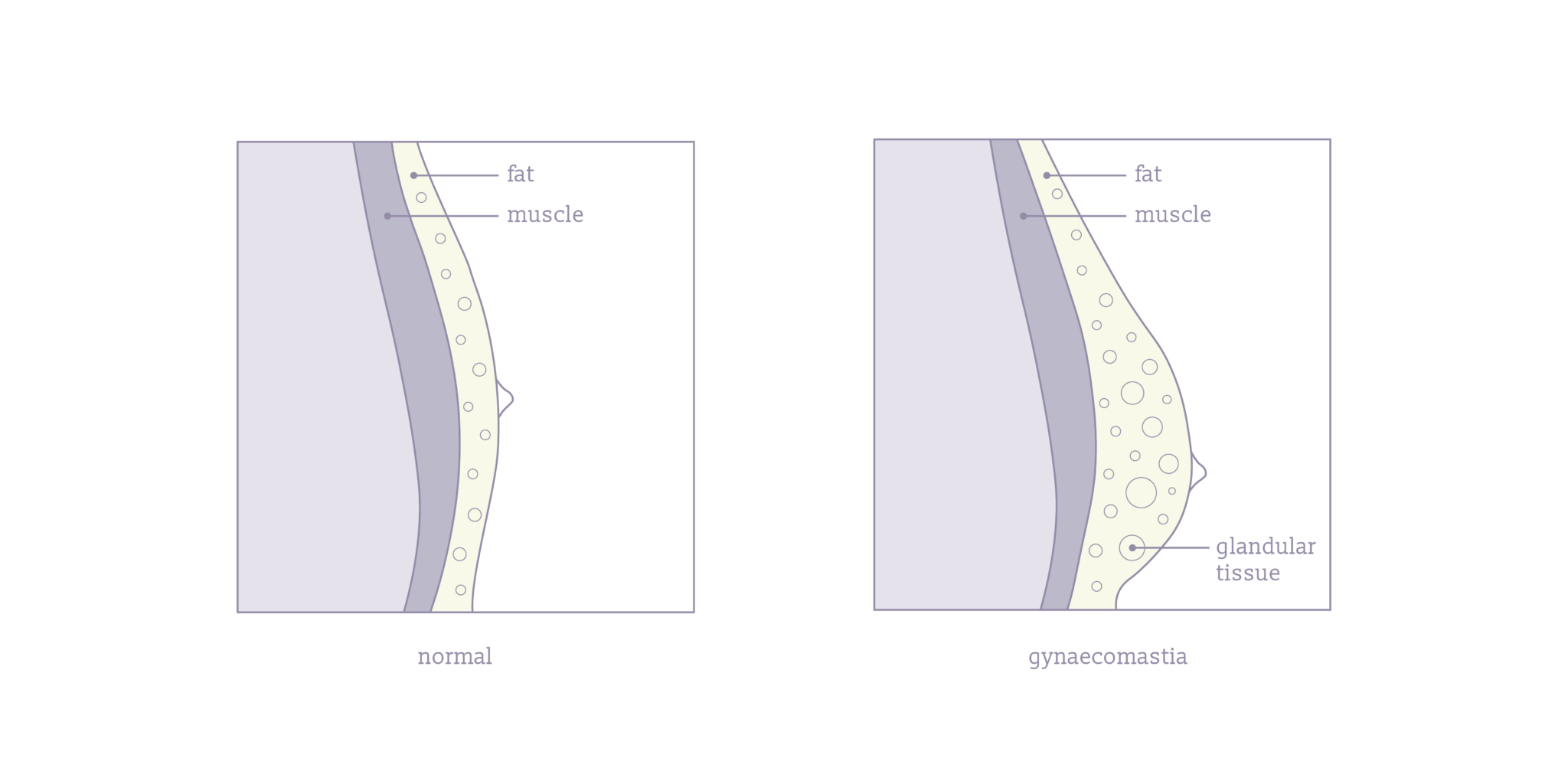 Gynaecomastia Surgery | complete guide for male breast reduction