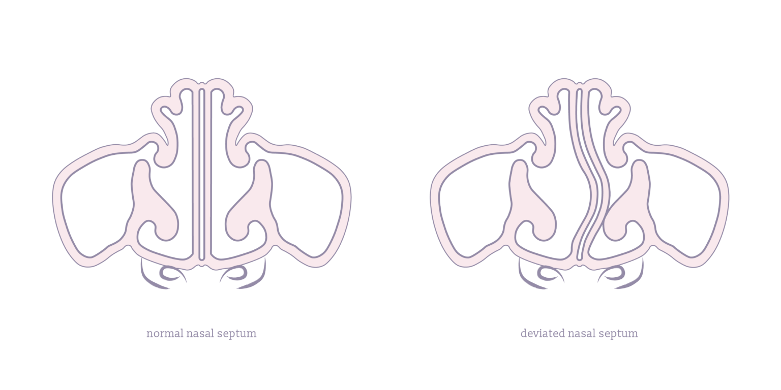 Septoplasty in Melbourne | Deviated Septum Surgery at Me Clinic