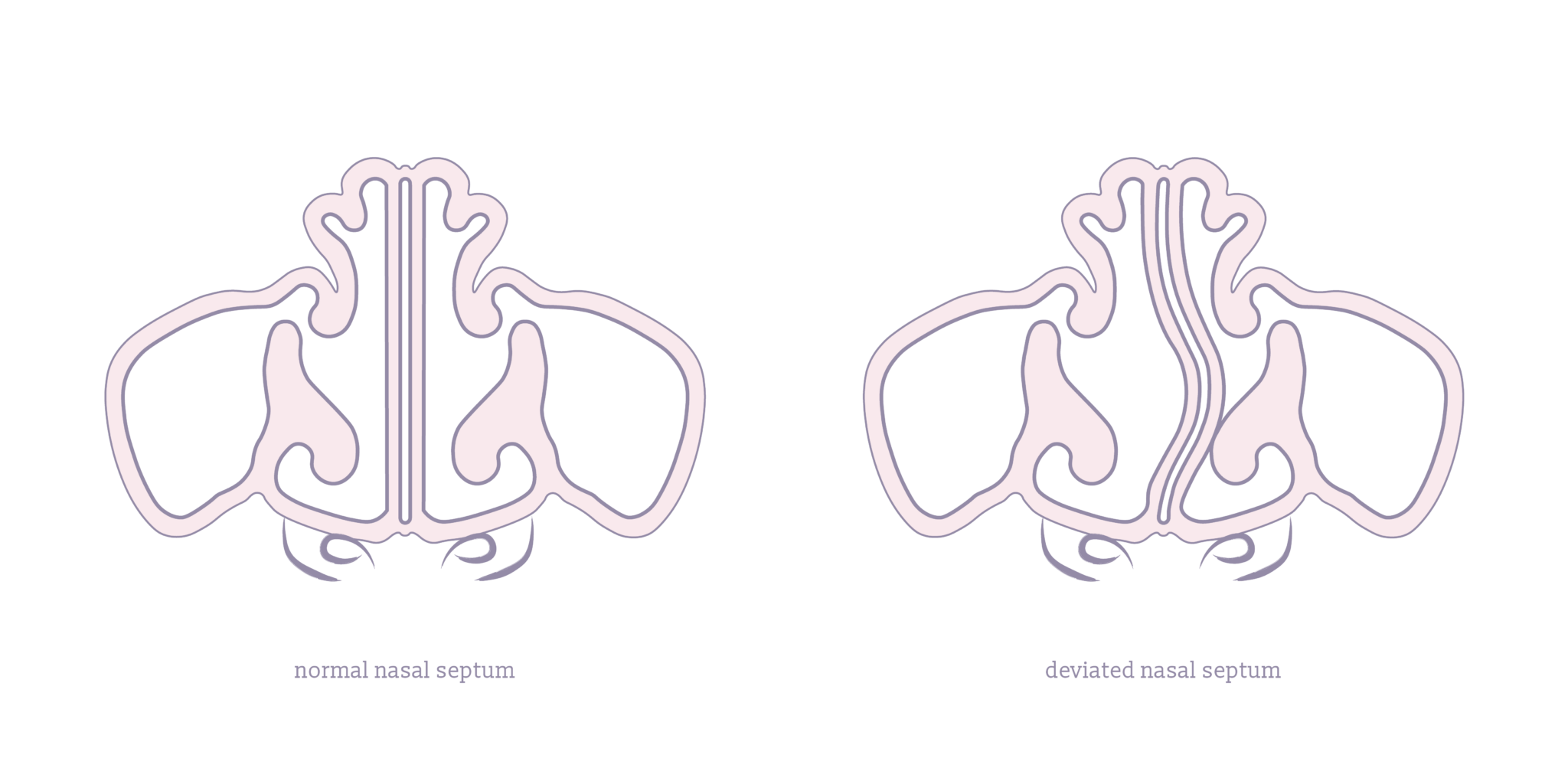 Septoplasty in Melbourne | Deviated Septum Surgery at Me Clinic