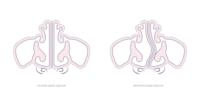 Septoplasty in Melbourne | Deviated Septum Surgery at Me Clinic