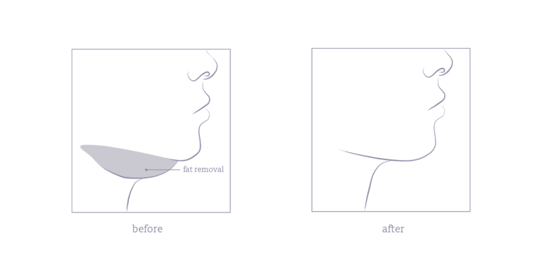 Jawline Contouring Treatment - introducing the Ku Lift™ | Me Clinic