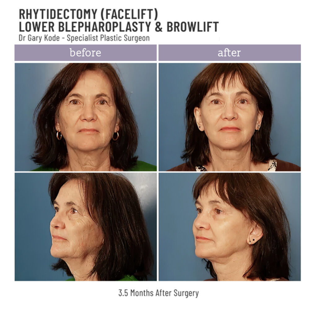 Face Lift Surgery - Before and After Patient Results