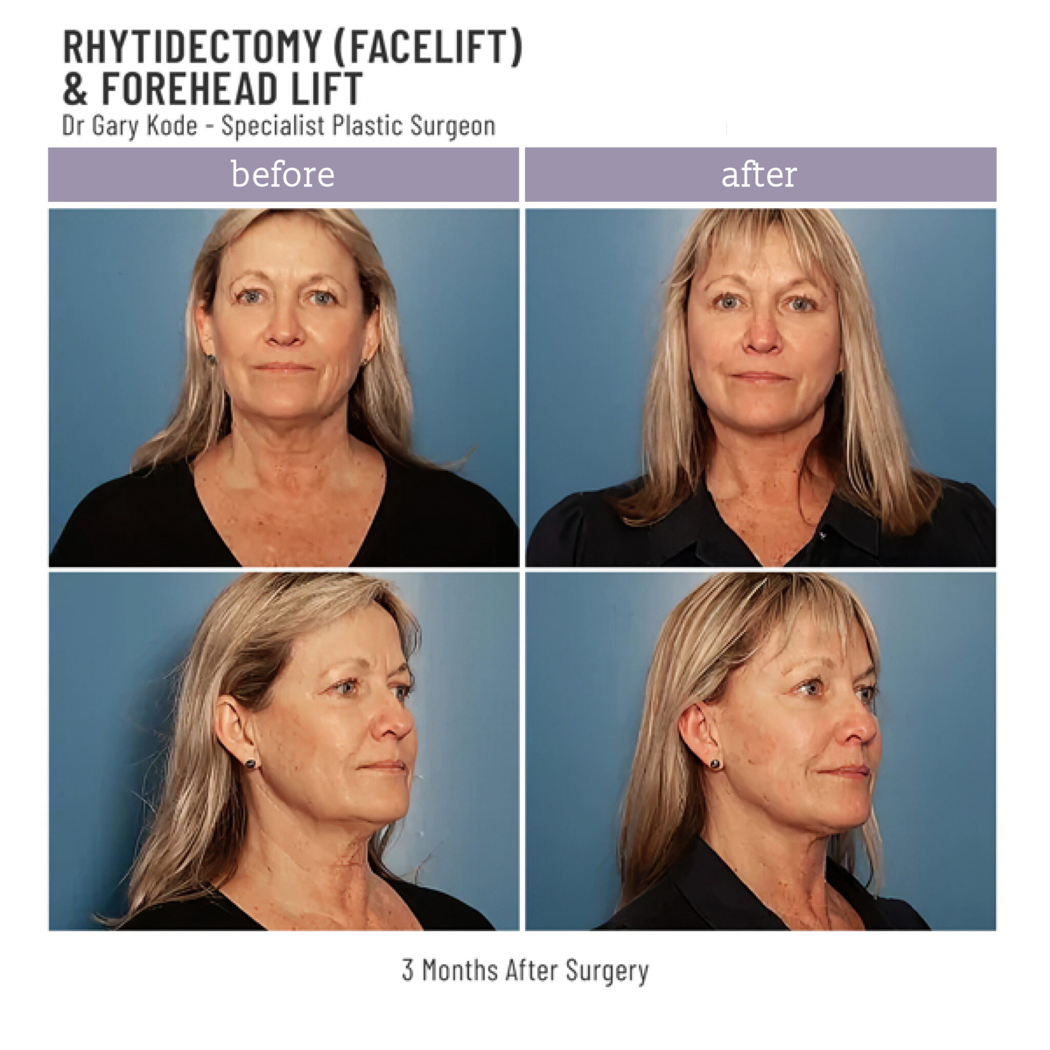 Face Lift Surgery - Before and After Patient Results